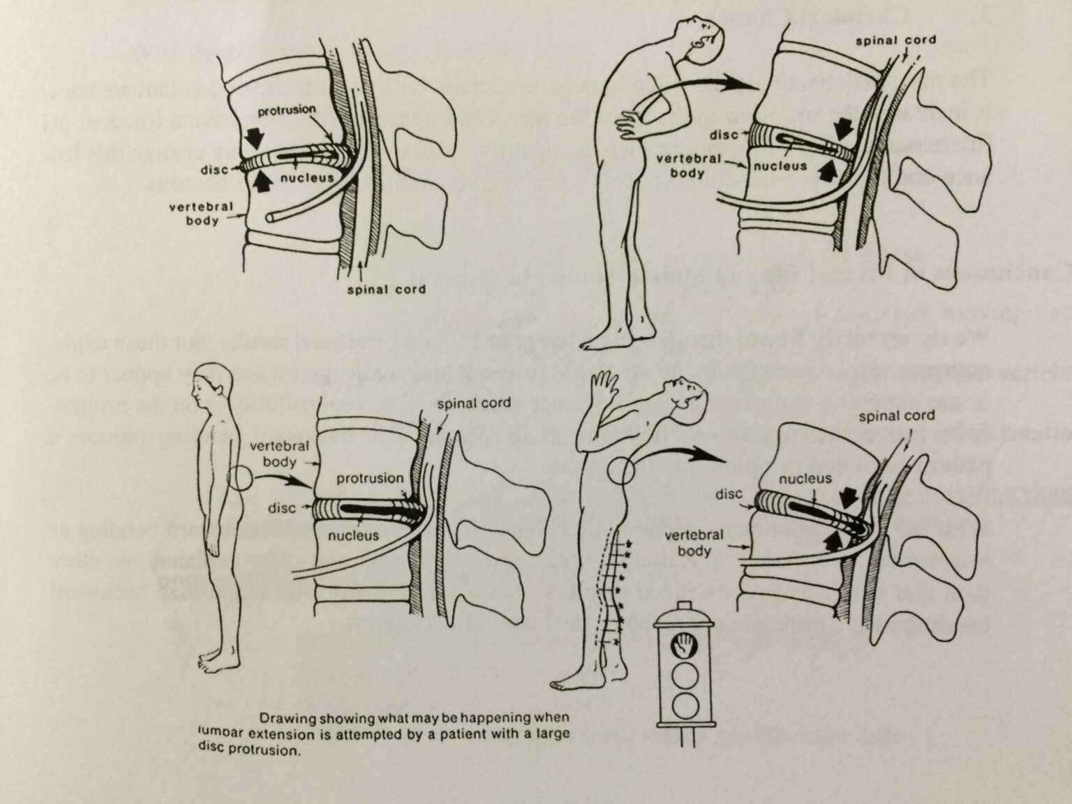 Low Back Pain Treated With Repeated Extension - PhysioStrength Physical ...
