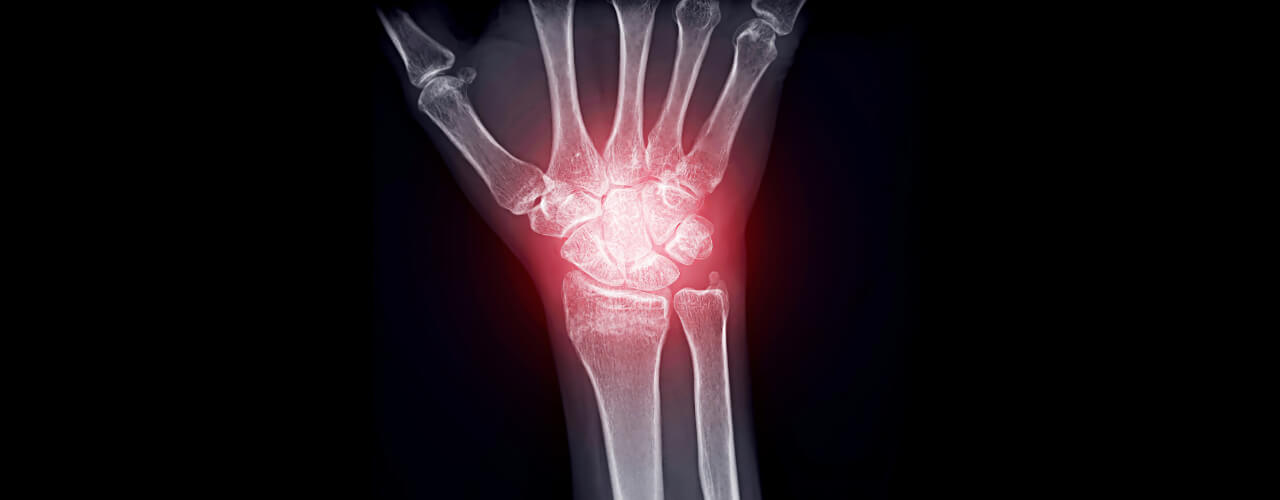 How to Manage Joint Inflammation from Arthritis - PhysioStrength ...